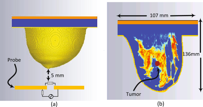 Near Field Breast Tumor Detection Using Ultra-Narrow Band Probe with ...