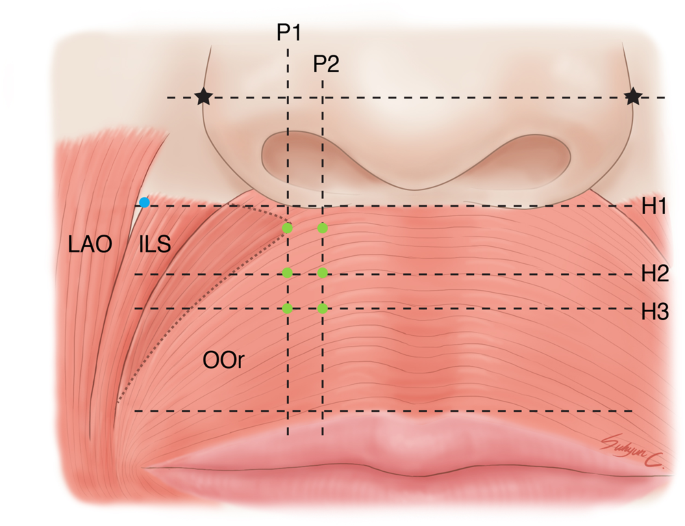 Anatomical features of the incisivus labii superioris muscle and its ...