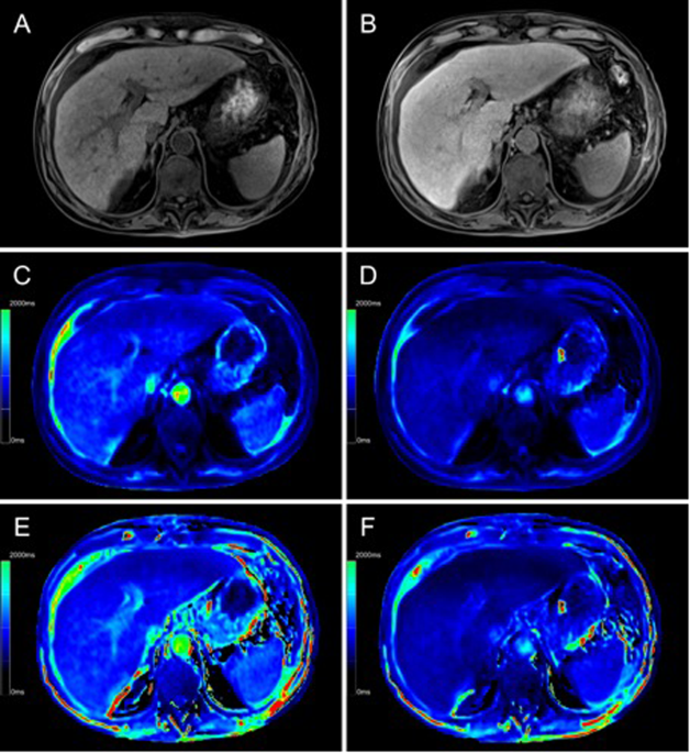 Evaluation of two-point Dixon water-fat separation for liver specific ...