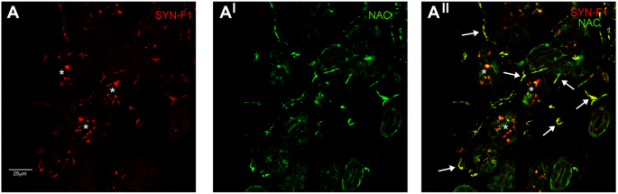 Skin α-synuclein deposits differ in clinical variants of ...