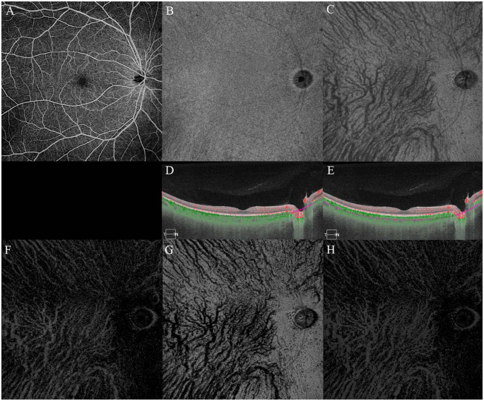 Visualizing large choroidal blood flow by subtraction of the ...