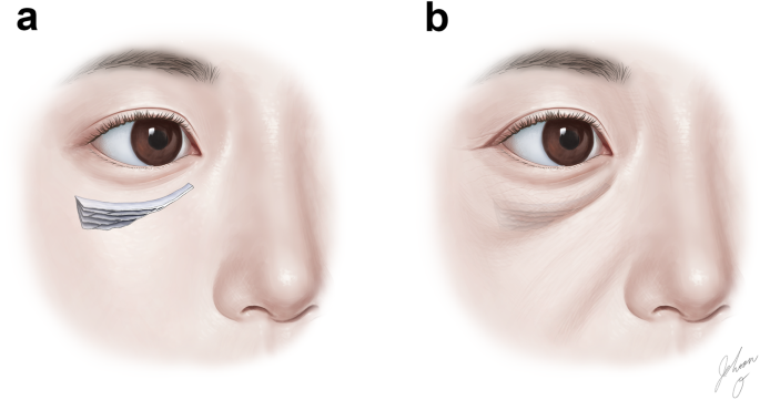 Three-dimensional structure of the orbicularis retaining ligament: an ...