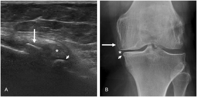 Ultrasonography of the late-stage knee osteoarthritis prior to total ...