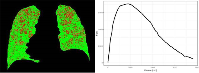 New Spirometry Indices for Detecting Mild Airflow Obstruction ...