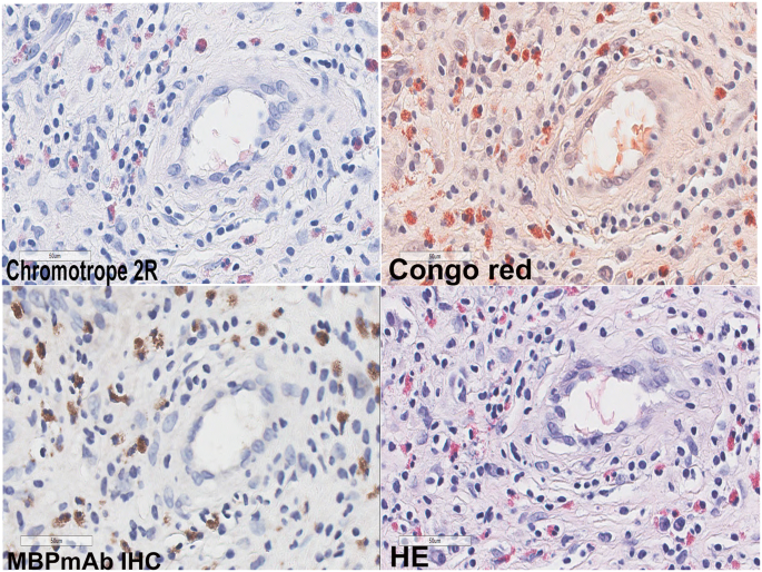 Comparison of four staining methods for detecting eosinophils in nasal ...