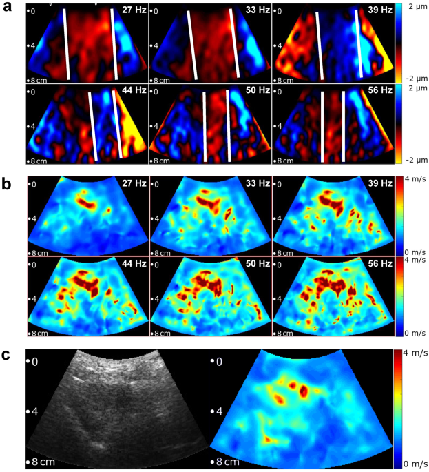 In vivo time-harmonic ultrasound elastography of the human brain ...