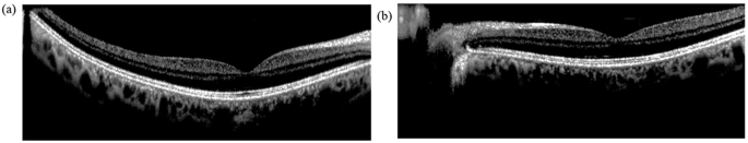 Akinetic swept-source optical coherence tomography based on a pulse-modulated active mode ...