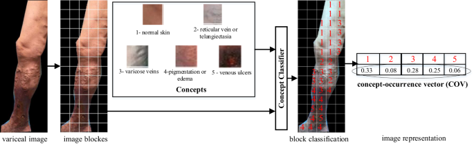 An Automatic Classification Method on Chronic Venous Insufficiency ...