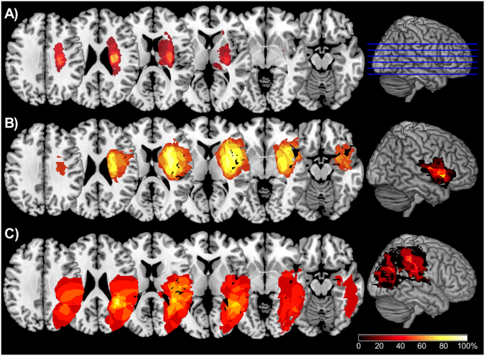 Damage to the right temporoparietal junction, but not lateral ...