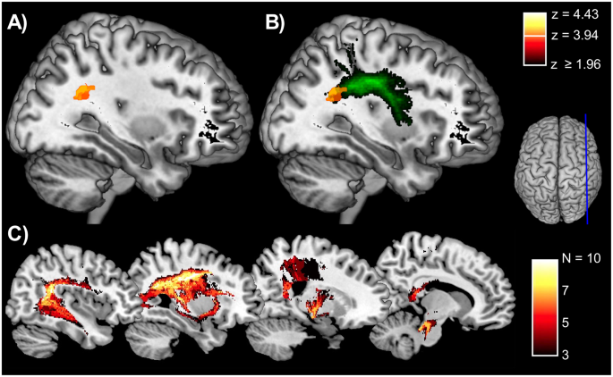 Damage to the right temporoparietal junction, but not lateral ...