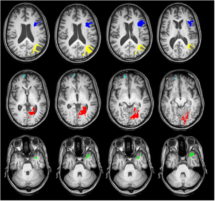 Hemispheric Regional Based Analysis of Diffusion Tensor Imaging and ...