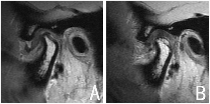 Can anterior repositioning splint effectively treat temporomandibular ...
