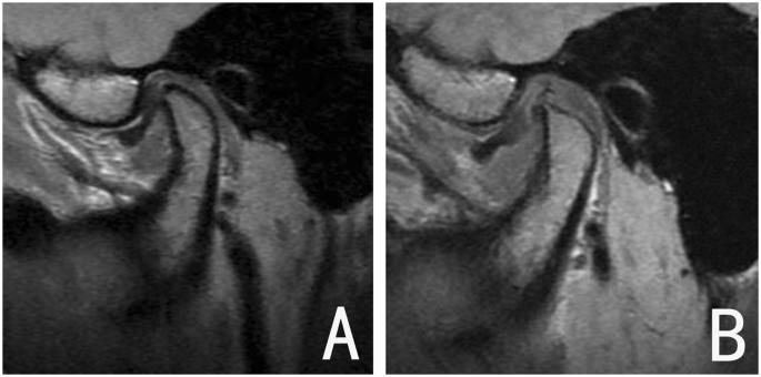 Can anterior repositioning splint effectively treat temporomandibular ...