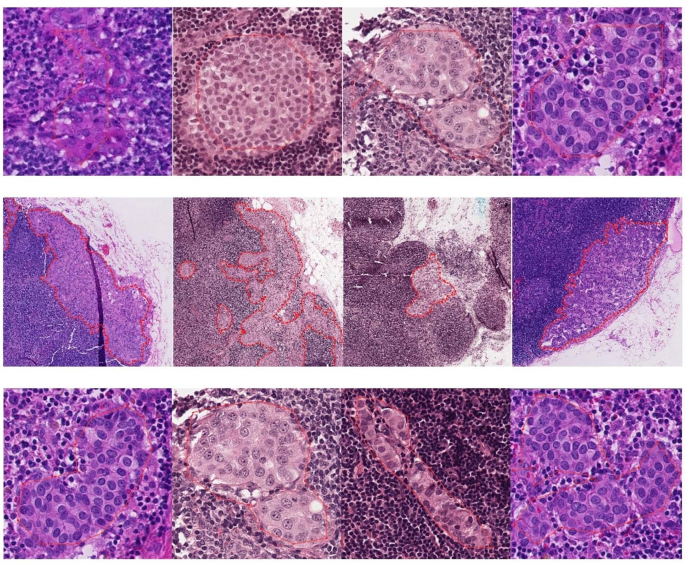 A Fast and Refined Cancer Regions Segmentation Framework in Whole-slide ...