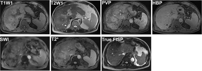 Gadoxetic Acid-Enhanced Hepatobiliary-Phase Magnetic Resonance Imaging ...