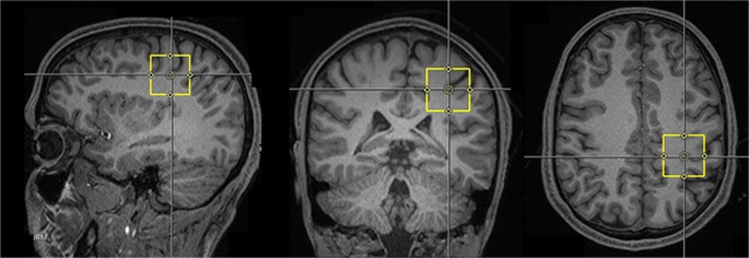 Proton Magnetic Resonance Spectroscopy of the motor cortex reveals long ...