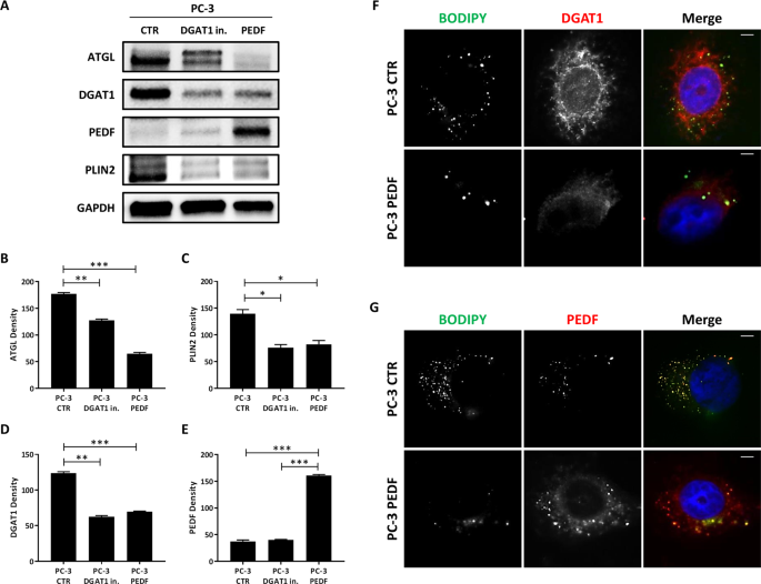 DGAT1 Inhibitor Suppresses Prostate Tumor Growth and Migration by ...