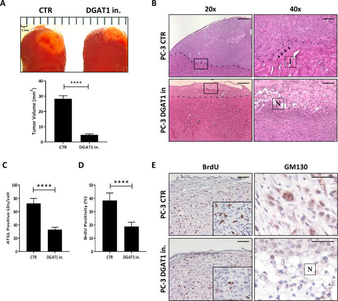 DGAT1 Inhibitor Suppresses Prostate Tumor Growth and Migration by ...