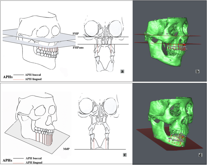 Two-year observation of the occlusal vertical dimension after bite ...