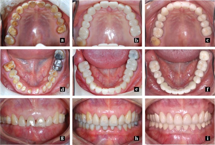 Two-year observation of the occlusal vertical dimension after bite ...