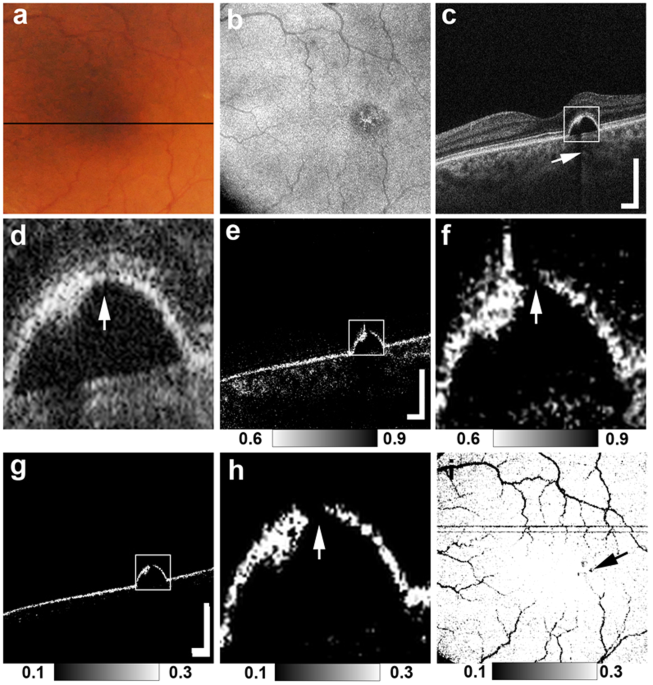 Evaluation of focal damage in the retinal pigment epithelium layer in ...