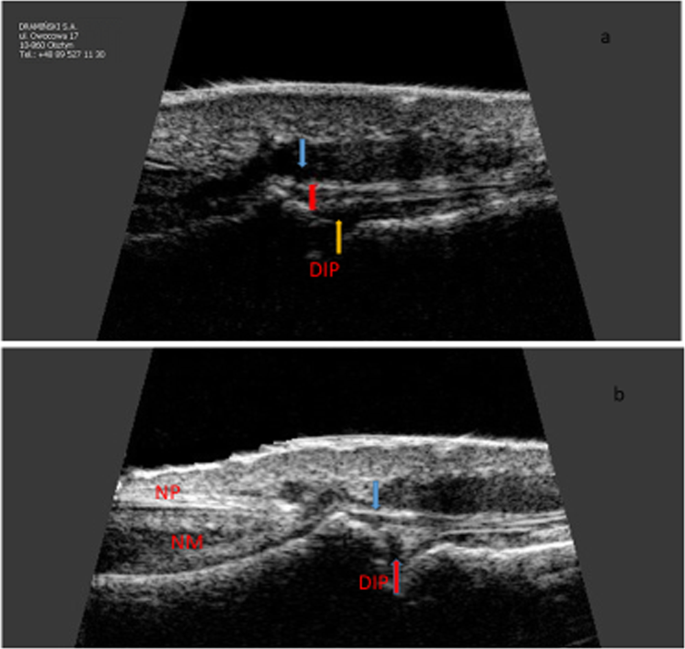 Distal interphalangeal joint extensor tendon enthesopathy in patients ...