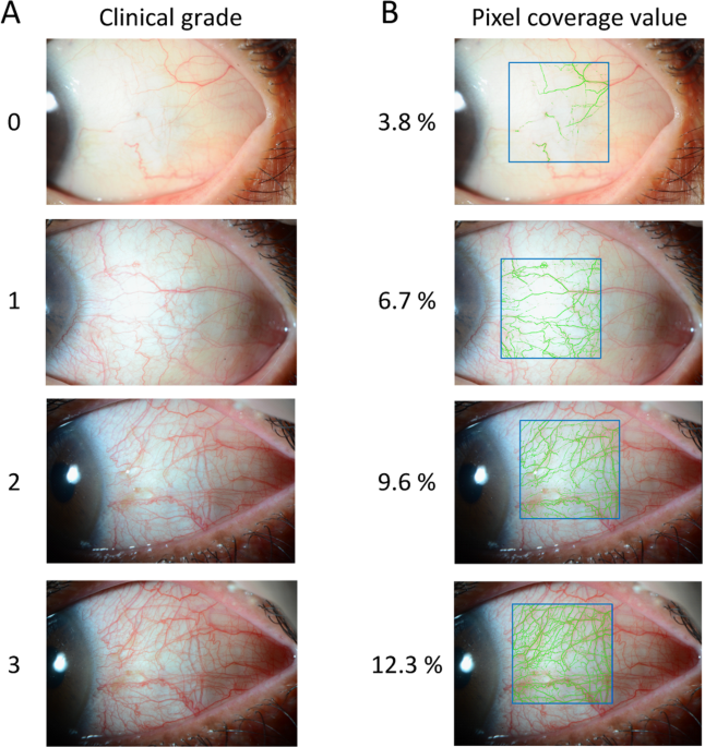 Evaluation of offset of conjunctival hyperemia induced by a Rho-kinase ...