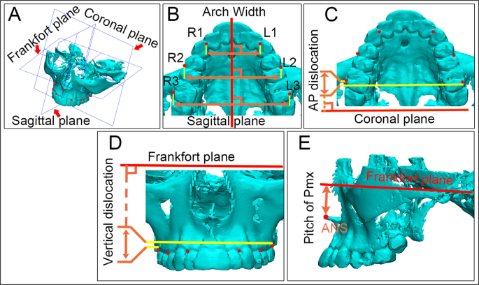 Functional stability analyses of maxillofacial skeleton bearing cleft ...