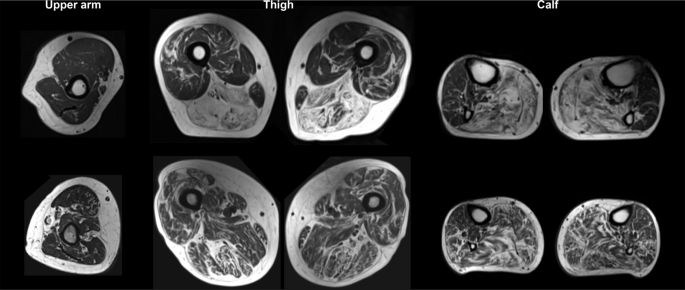 Muscle contractility in spinobulbar muscular atrophy | Scientific Reports