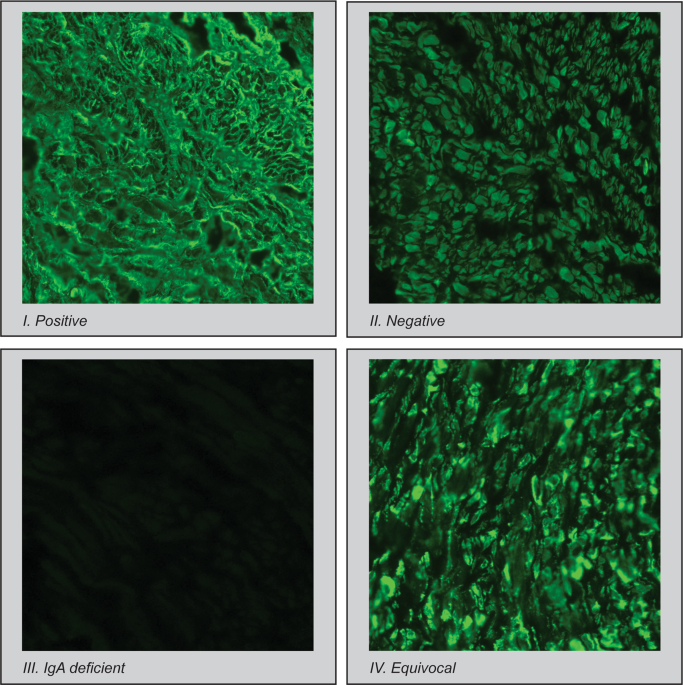 Automatic classification of IgA endomysial antibody test for celiac ...