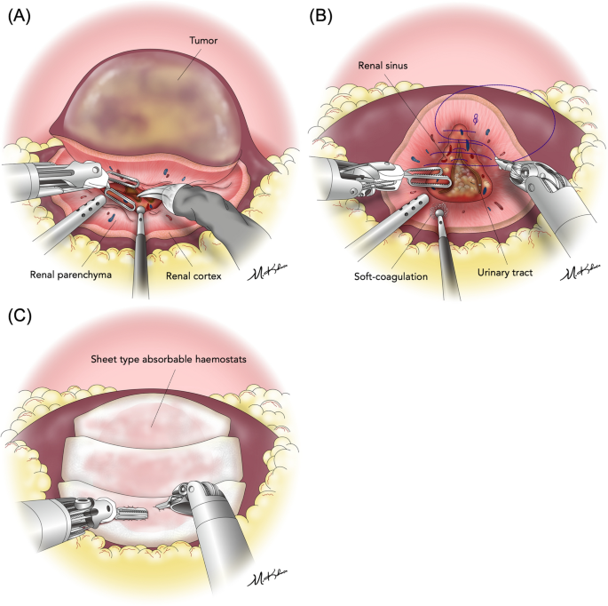 Surgical and functional outcomes of robot-assisted versus laparoscopic partial nephrectomy with ...
