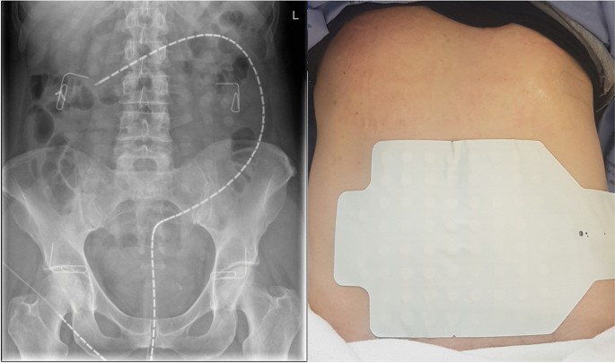 Validation of body surface colonic mapping (BSCM) against high ...