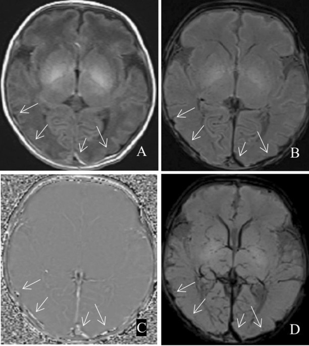 Incidence and clinical analysis of asymptomatic intracranial hemorrhage ...