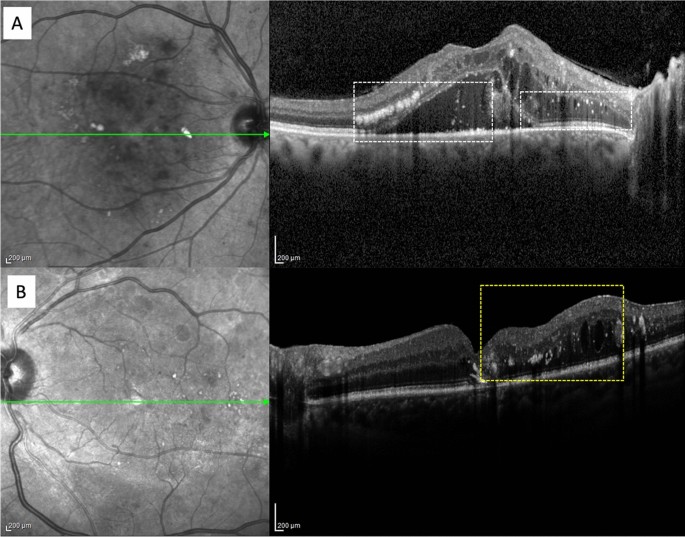 A deep learning approach to hard exudates detection and disorganization ...