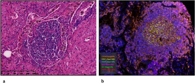 The impact of tertiary lymphoid structures on tumor prognosis and the ...