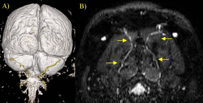 Preoperative visualization of the greater occipital nerve with magnetic ...
