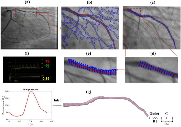 Non-invasive fractional flow reserve estimation in coronary arteries using angiographic images ...