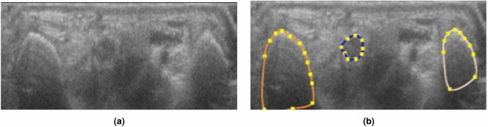 Automated segmentation of the median nerve in patients with carpal tunnel syndrome | Scientific ...