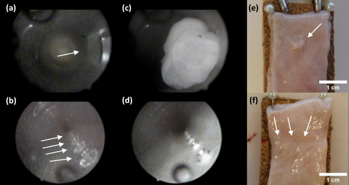 Reduction in lower urinary tract mucosal microtrauma as an effect of ...