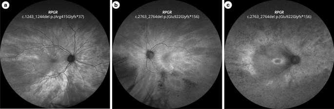 Exploring self-reported visual function and vision-related anxiety in ...