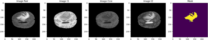 Enhancing brain tumor segmentation in MRI images using the IC-net ...