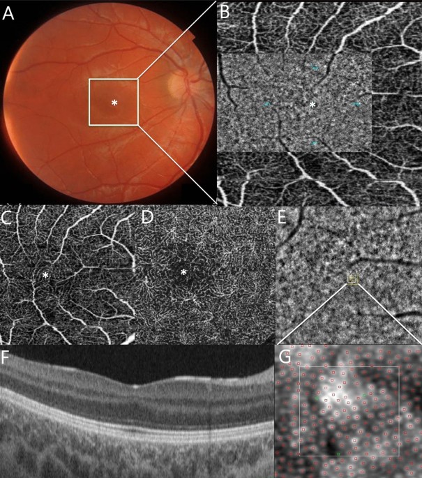 Multimodal phenotyping of foveal hypoplasia in albinism and albino-like ...