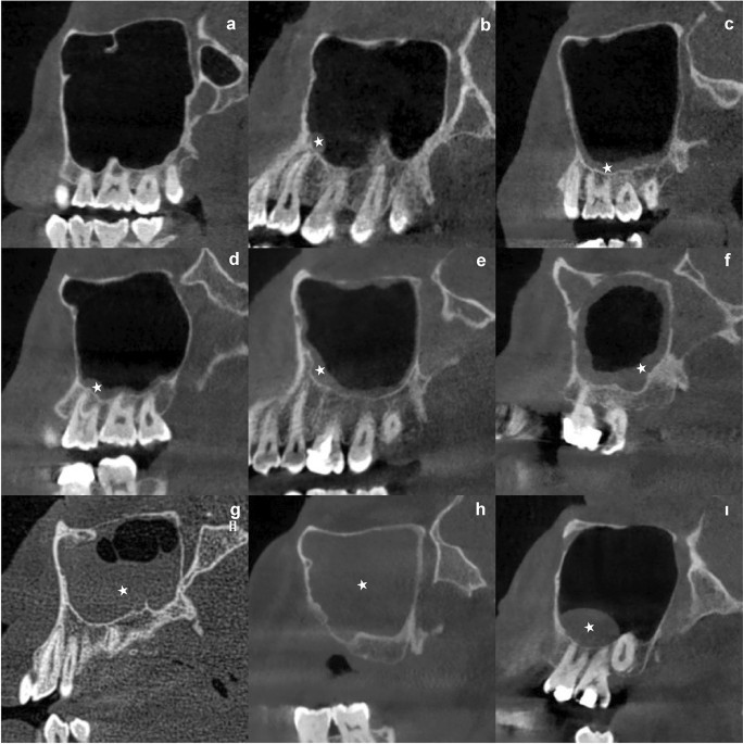 Retrospective analysis of pathological changes in the maxillary sinus ...