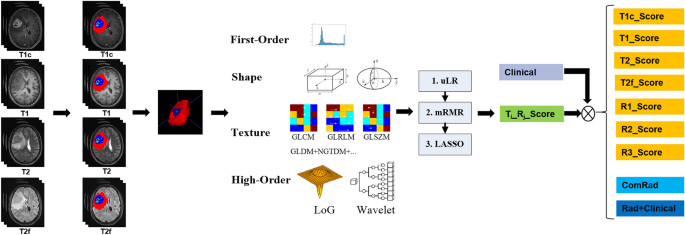 Preoperative prediction of MGMT promoter methylation in glioblastoma based on multiregional and ...