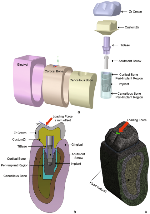 Multi-objective optimization of custom implant abutment design for enhanced bone remodeling in ...
