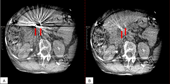 Evaluation of a prototype metal artifact reduction algorithm for cone ...