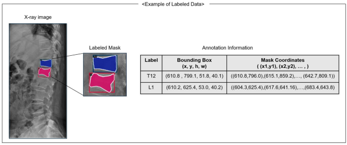 Deep learning application of vertebral compression fracture detection using mask R-CNN ...