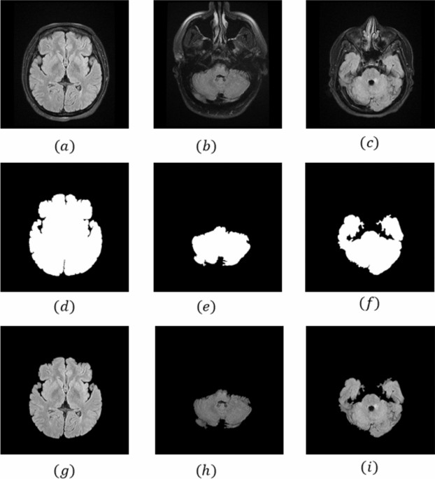 Efficient segmentation of active and inactive plaques in FLAIR-images using DeepLabV3Plus SE ...