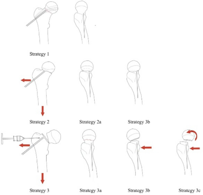 Precision reduction of femoral neck fractures: a novel strategy based ...