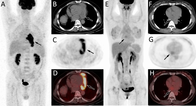 18F-FDG PET/CT metabolic parameters can semi-quantitatively evaluate the nature of the heart and ...